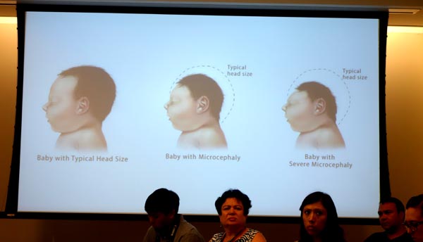 Nace en NY el primer bebé con microcefalia | Queens Latino